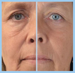 Microcurrent Therapy | Facial Toning | Best Facial Toning Devices ...